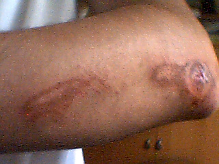 Abrasion - RunnersMD