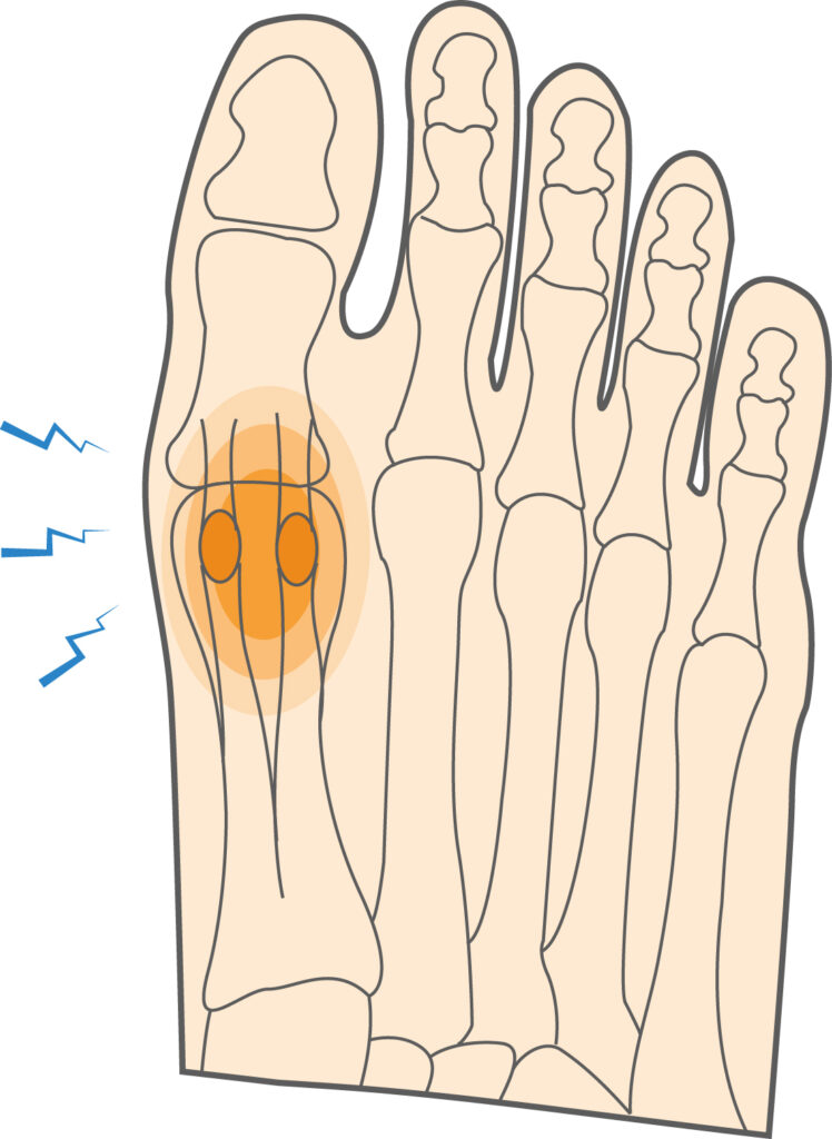 Sesamoiditis - RunnersMD