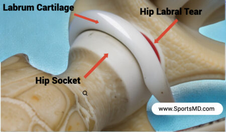 Front hip pain - RunnersMD